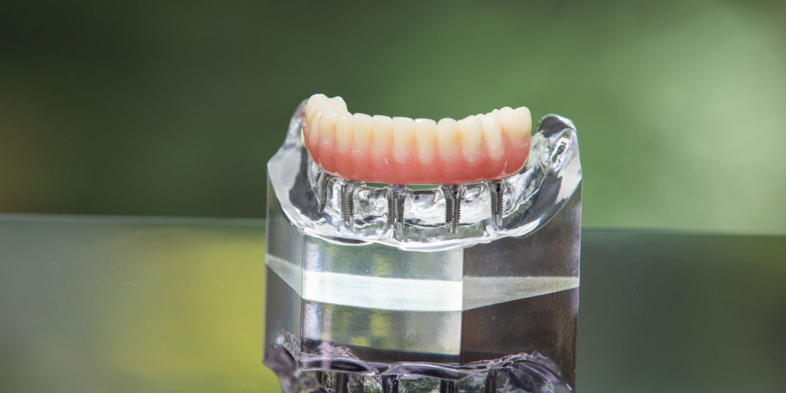 Understanding Dental Implants: How and When You Can Get All Your Teeth ...